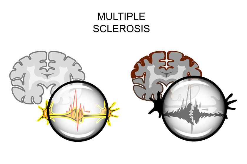 What Does Multiple Sclerosis (MS) Look Like In Seniors? Learn The 4 ...